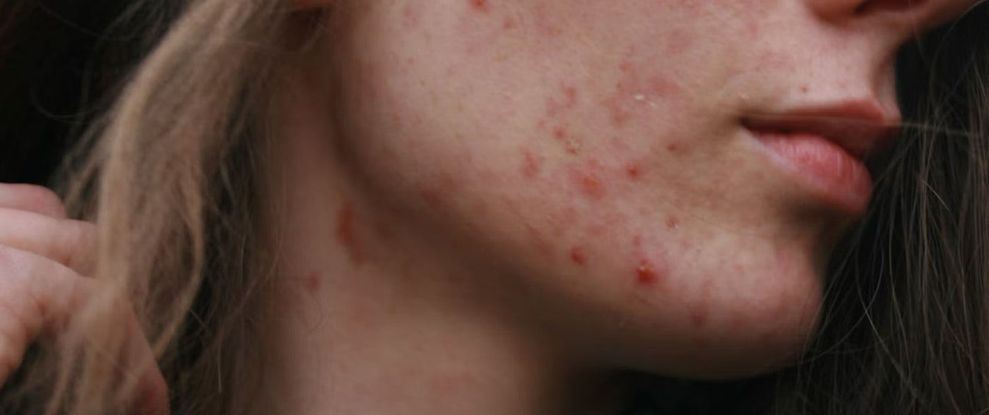 Skin purging vs. breakouts after a facial: how to tell the difference ...