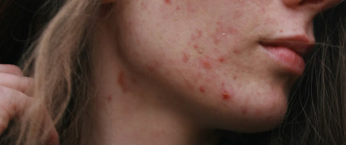 Skin purging vs. breakouts after a facial: how to tell the difference ...